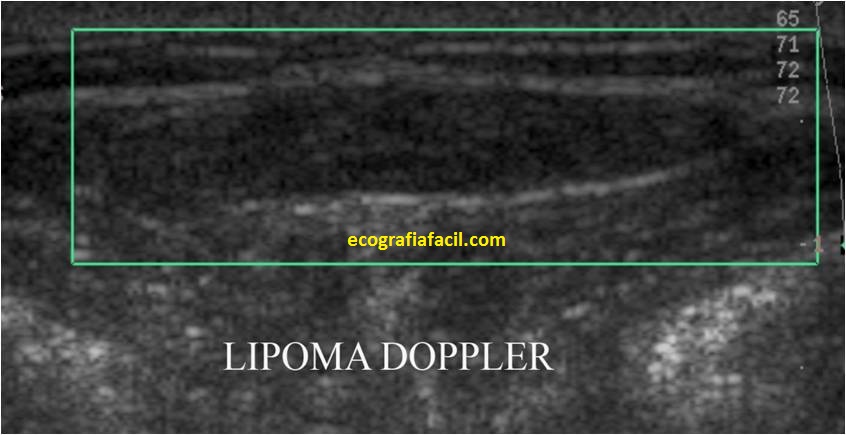 Lipoma – Ecografía Fácil