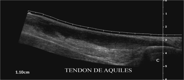Longitudinal – Ecografía Fácil