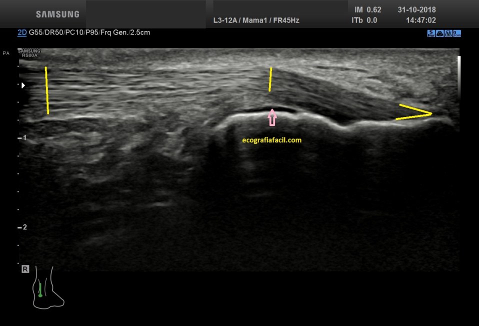 Longitudinal – Ecografía Fácil