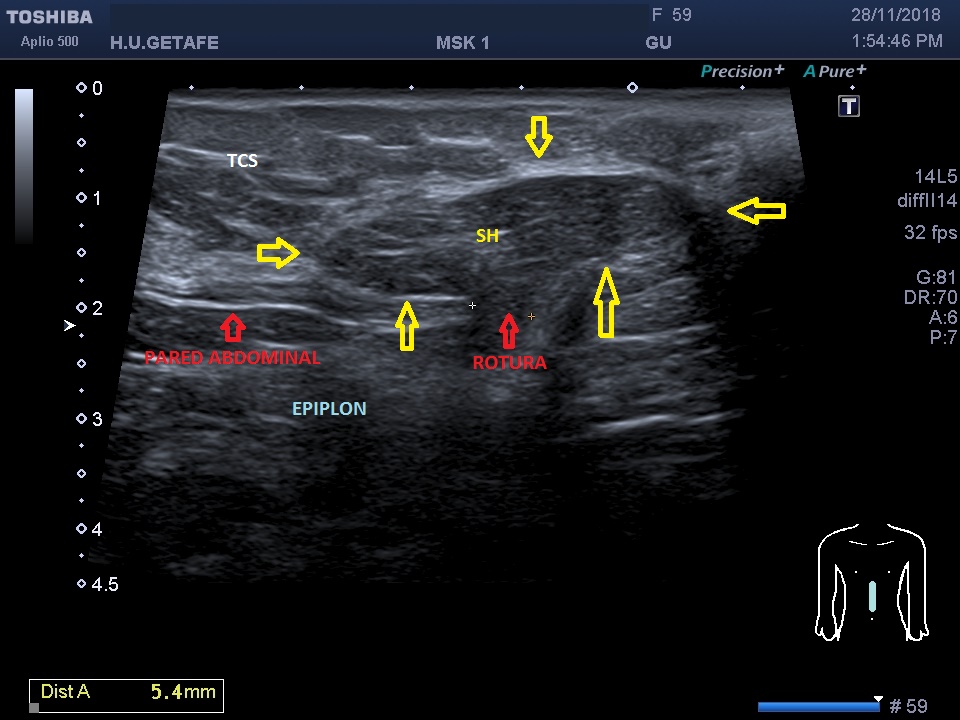 Spiegel – Ecografía Fácil
