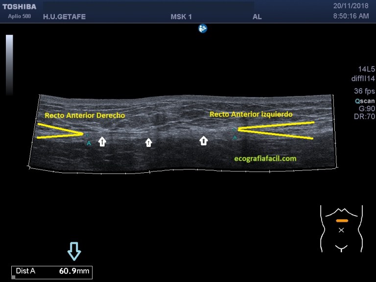 Inguinal – Ecografía Fácil