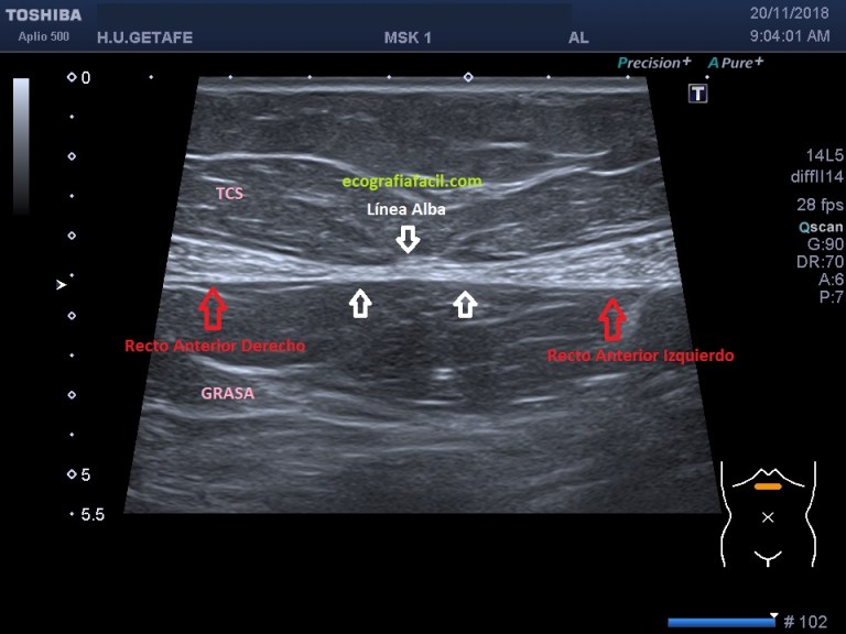 Inguinal – Ecografía Fácil
