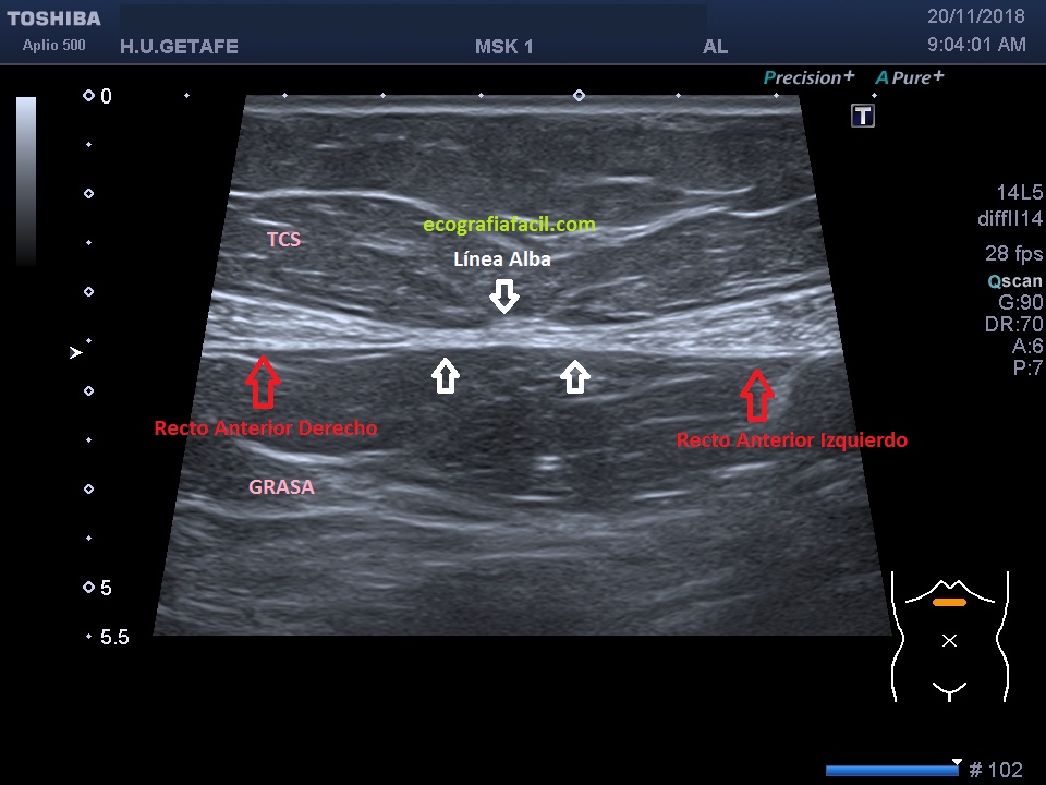 Diástasis – Ecografía Fácil