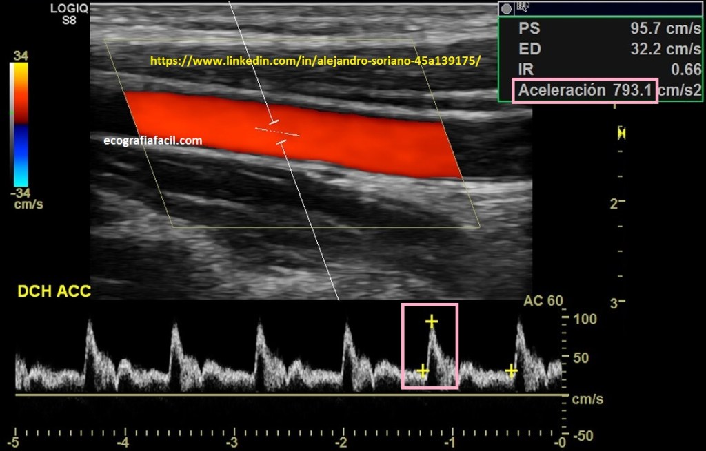 104. Doppler TSA. – Ecografía Fácil
