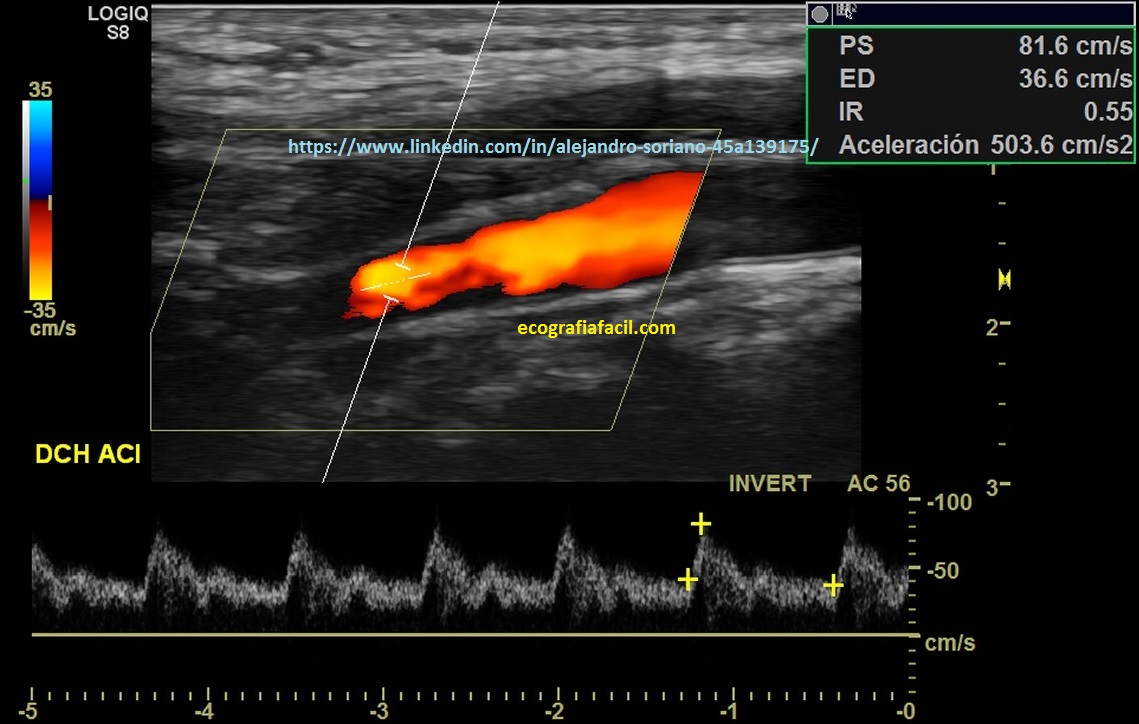 104. Doppler TSA. – Ecografía Fácil