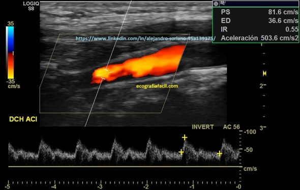 104. Doppler TSA. – Ecografía Fácil