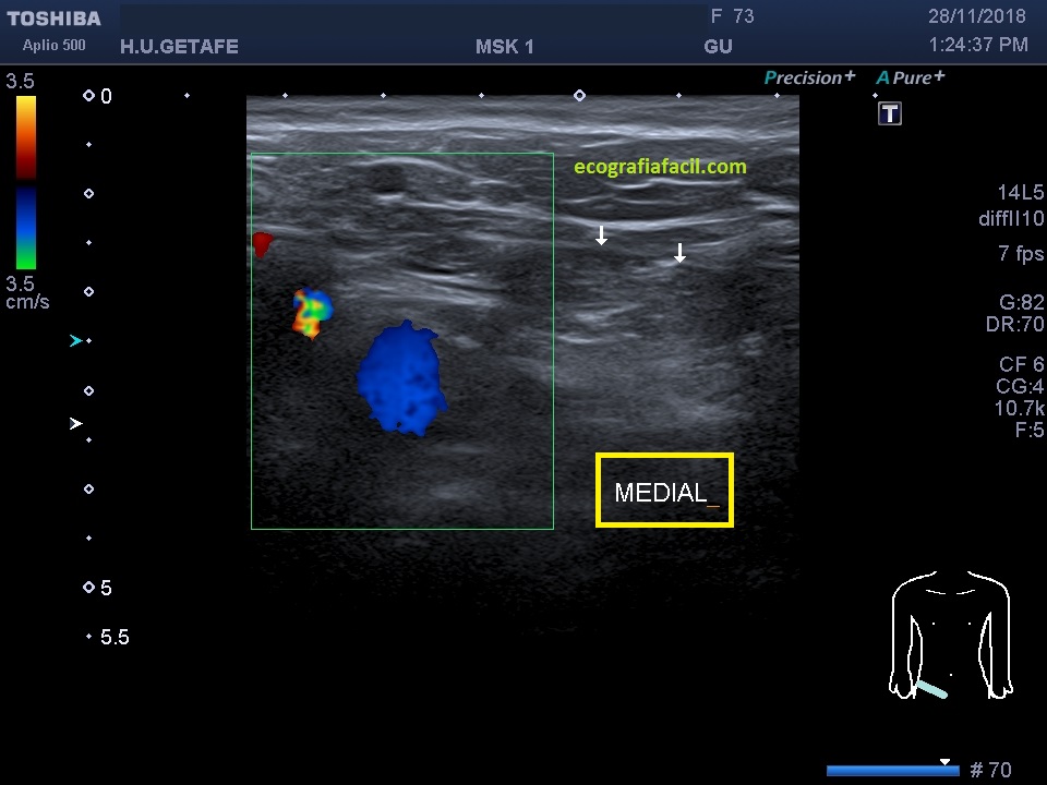 Inguinal – Ecografía Fácil