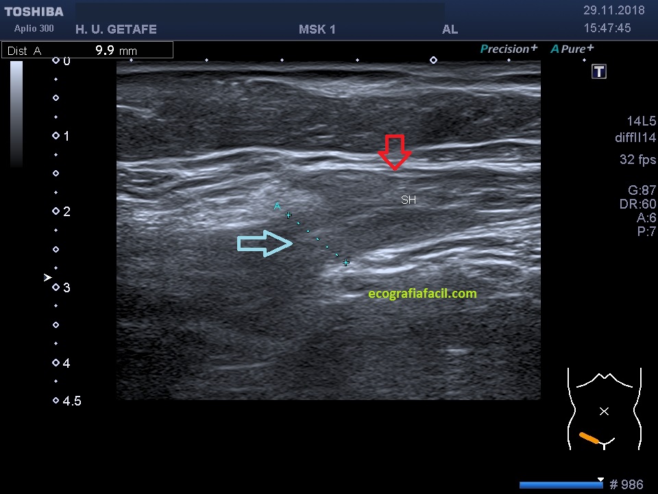 Inguinal – Ecografía Fácil