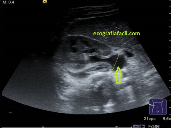 110. Hidronefrosis. – Ecografía Fácil