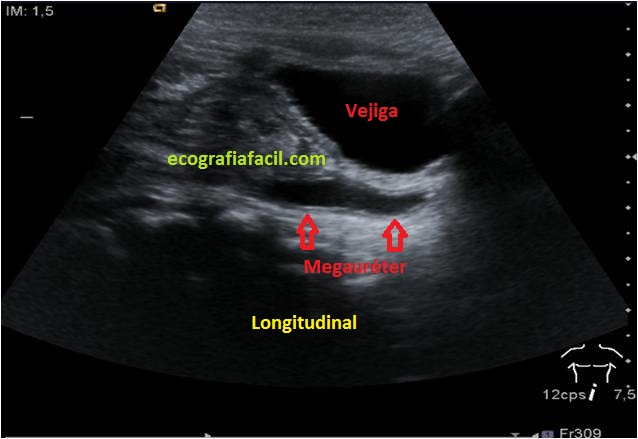 112 Megauréteres. – Ecografía Fácil