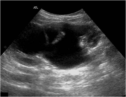 110. Hidronefrosis. – Ecografía Fácil