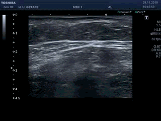 Inguinal – Ecografía Fácil