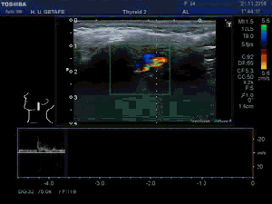 104. Doppler TSA. – Ecografía Fácil