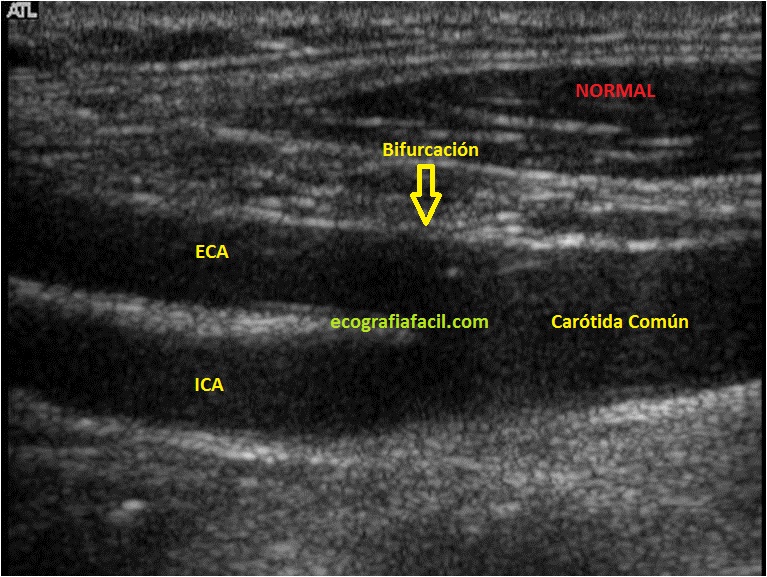 Carótida – Ecografía Fácil