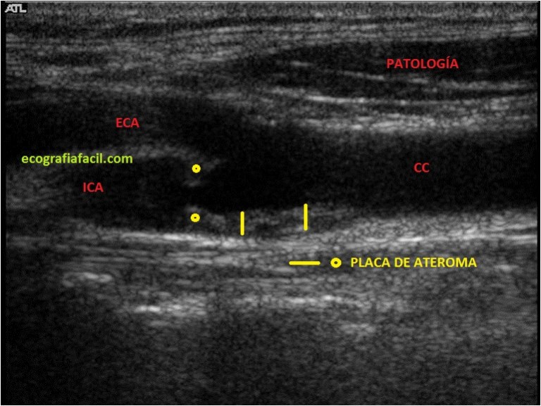 104. Doppler TSA. – Ecografía Fácil