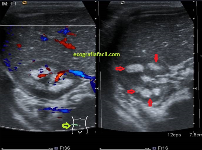 Nefrocalcinosis. – Ecografía Fácil