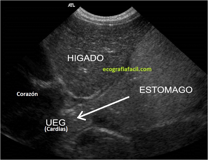Reflujo Gastroesofágico por Ecografía – Ecografía Fácil