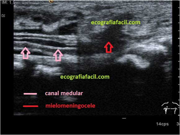 Médula Anclada – Ecografía Fácil