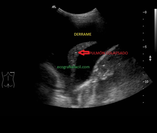 135. El Tórax. – Ecografía Fácil