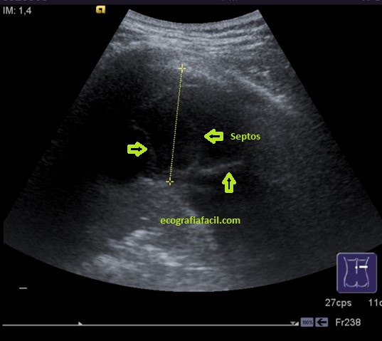 135. El Tórax. – Ecografía Fácil