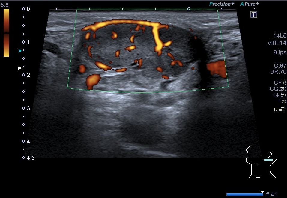 Ganglios – Ecografía Fácil