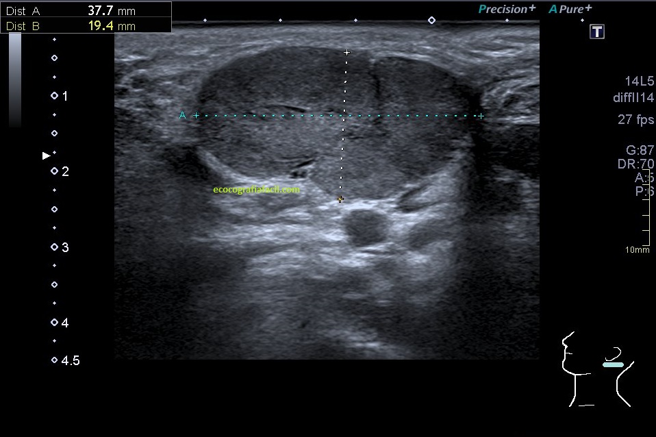 Ganglio por ecografía – Ecografía Fácil