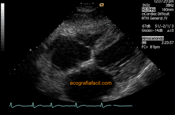 147. Ecocardiografía. Planos Subcostales. – Ecografía Fácil