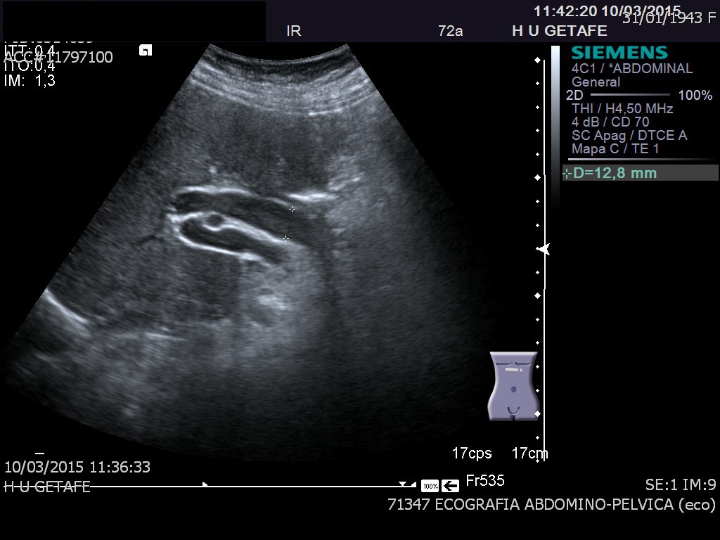 Colédoco – Ecografía Fácil