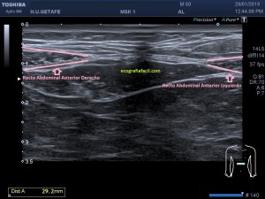 Isoecogénico – Ecografía Fácil