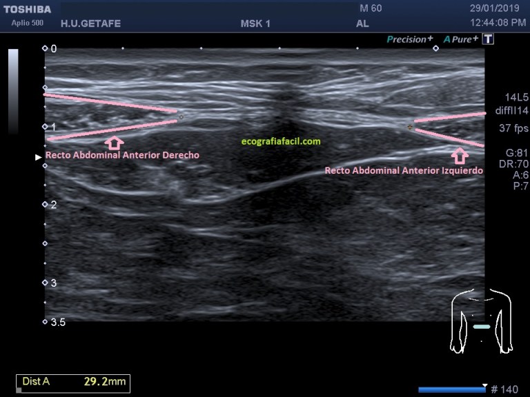 Isoecogénico – Ecografía Fácil