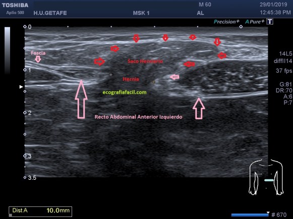 Isoecogénico – Ecografía Fácil