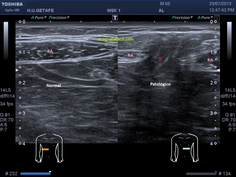 Isoecogénico – Ecografía Fácil