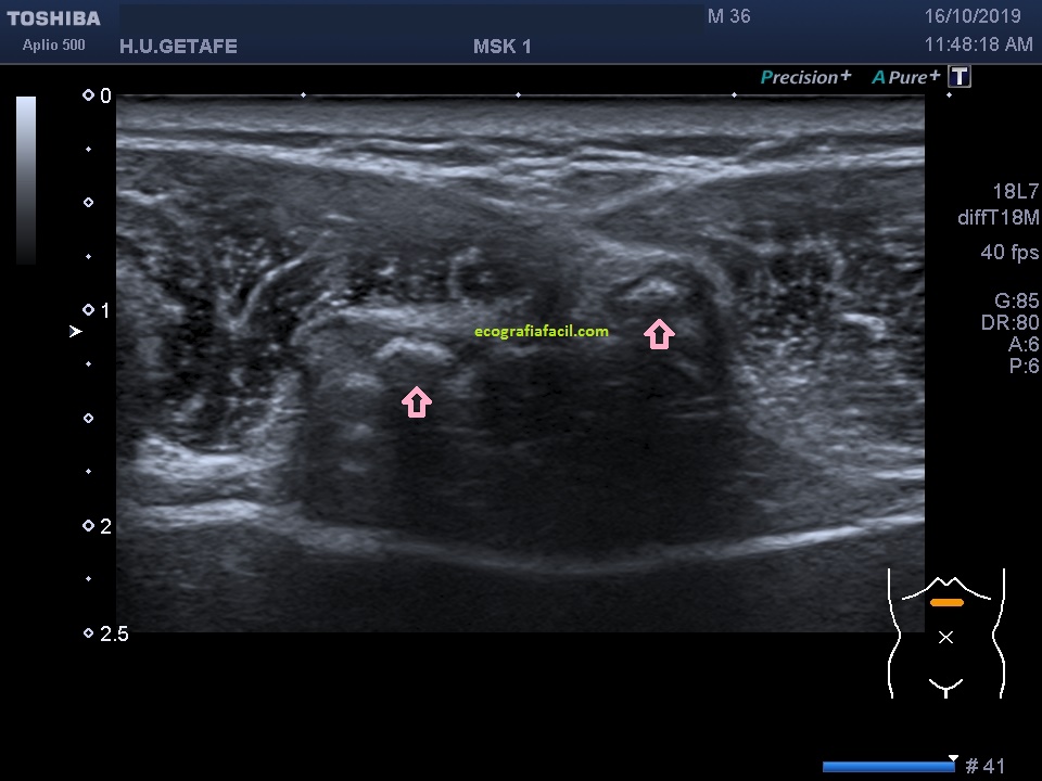 Apéndice Xifoides – Ecografía Fácil
