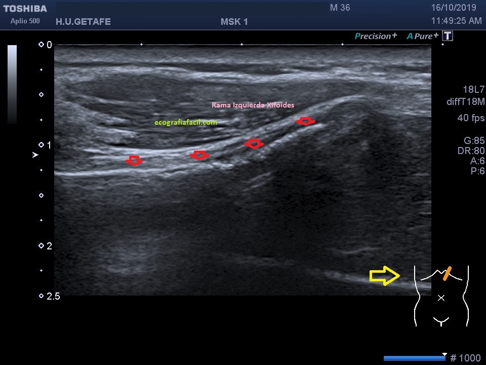 172. Apéndice Xifoides. – Ecografía Fácil