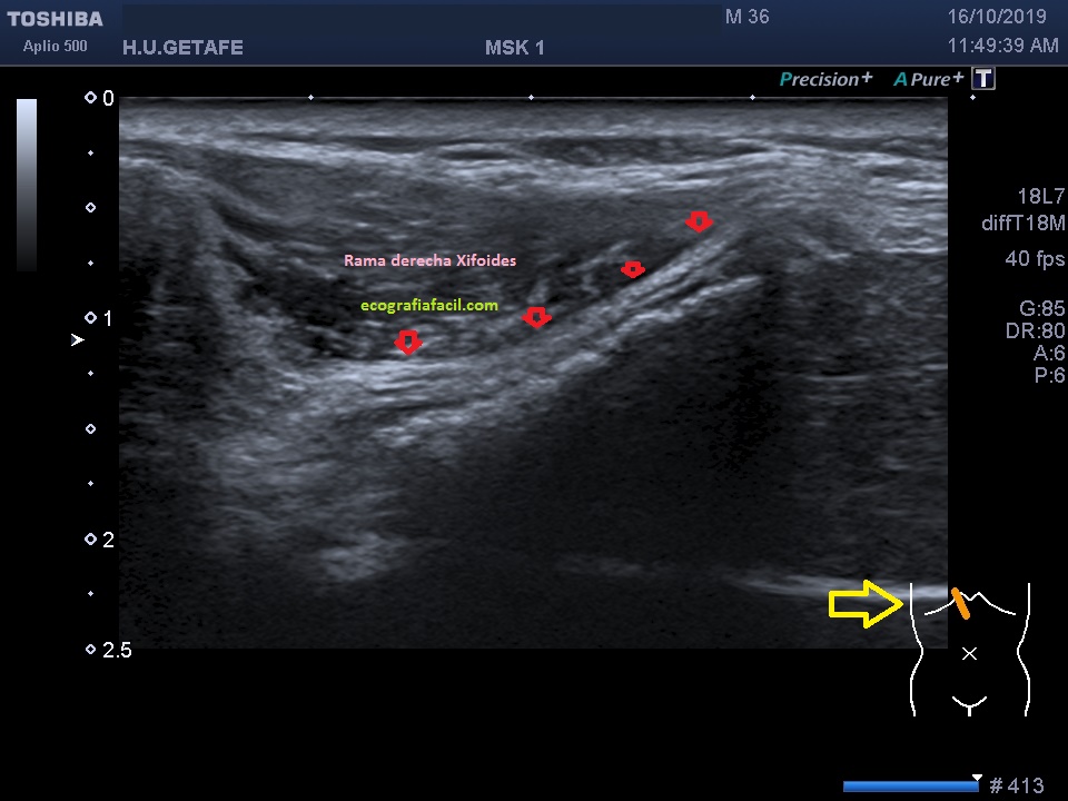 Apéndice Xifoides – Ecografía Fácil