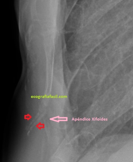 172. Apéndice Xifoides. – Ecografía Fácil