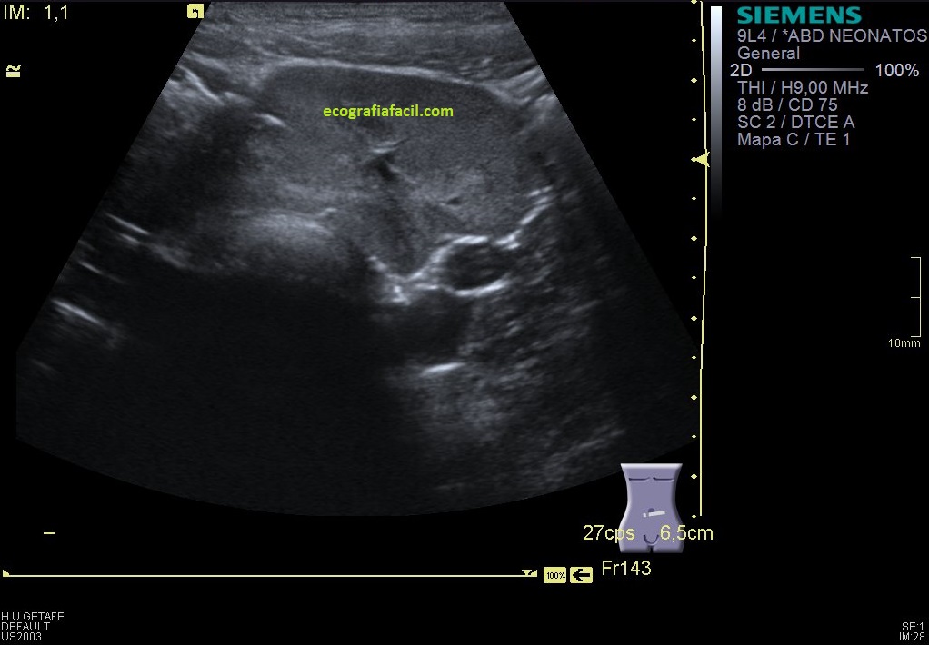 175. Ectopia Renal Cruzada. – Ecografía Fácil