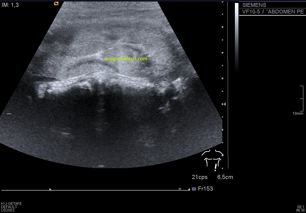 Ectopia Renal Cruzada – Ecografía Fácil