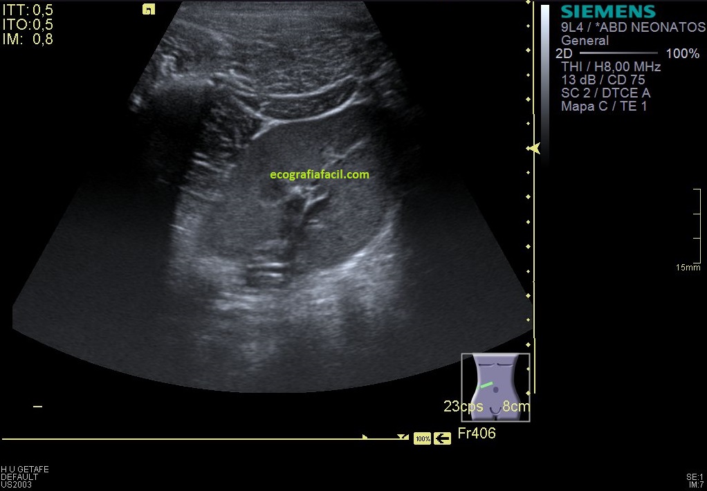Ectopia Renal Cruzada – Ecografía Fácil