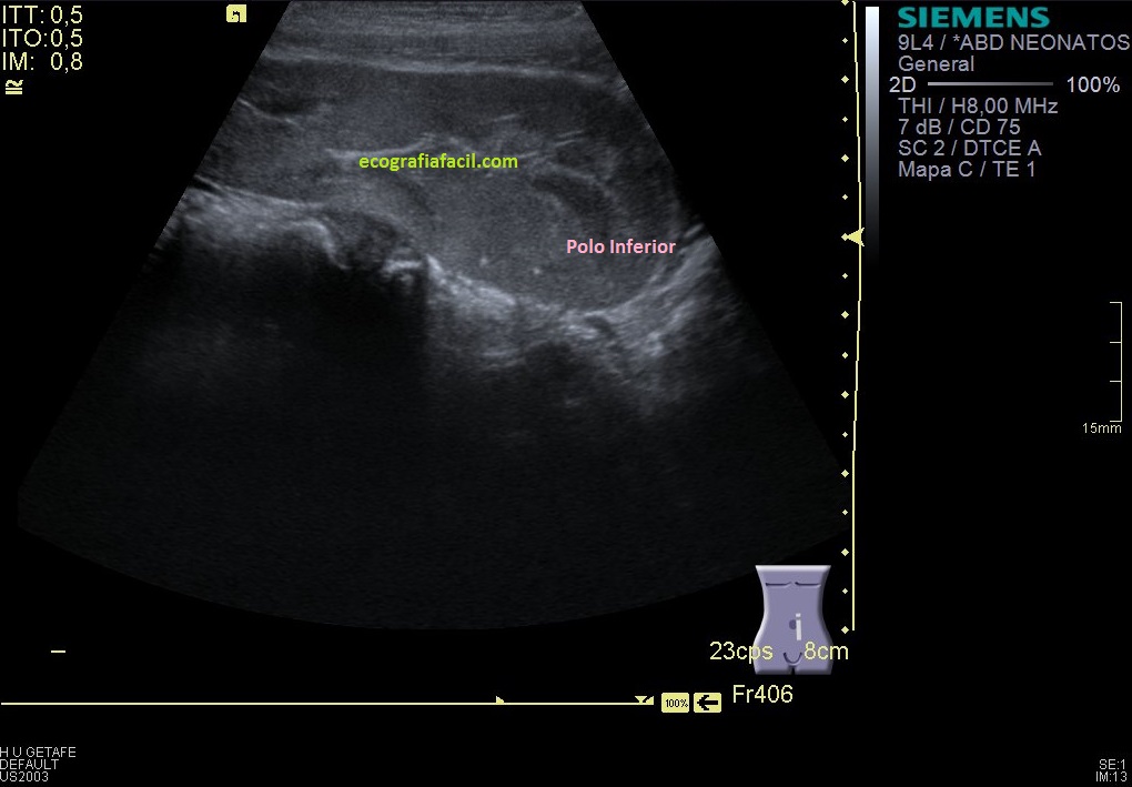 Ectopia Renal Cruzada – Ecografía Fácil