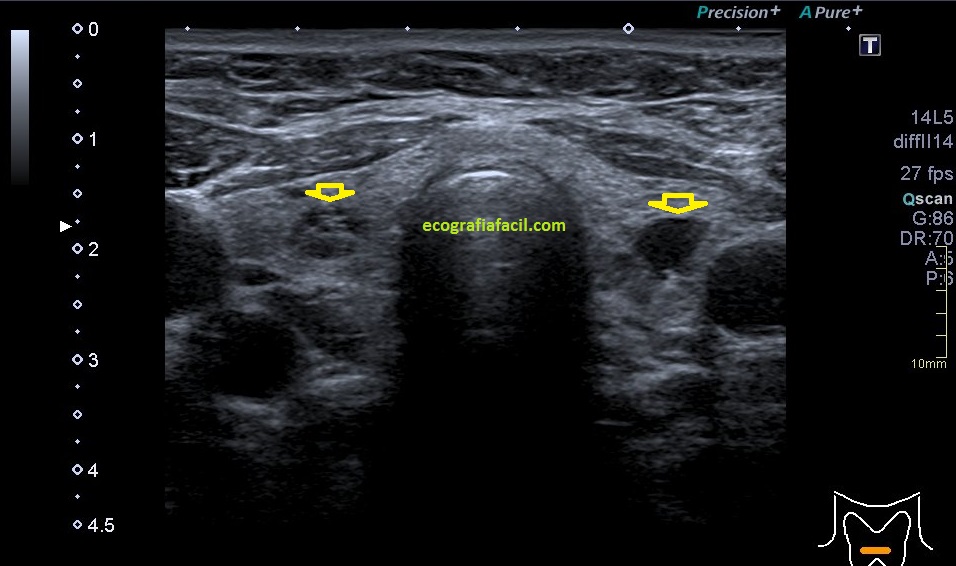 Tiroides – Ecografía Fácil