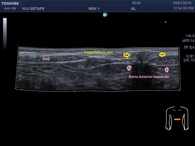 Isoecogénico – Ecografía Fácil
