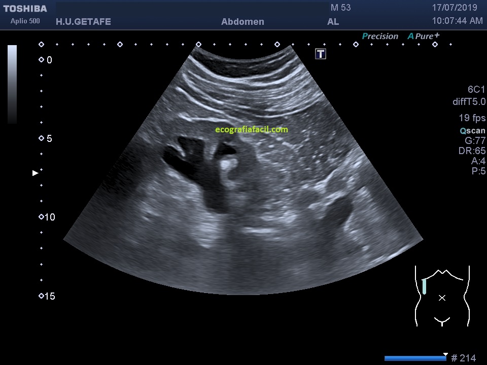 Dilatación Renal – Ecografía Fácil