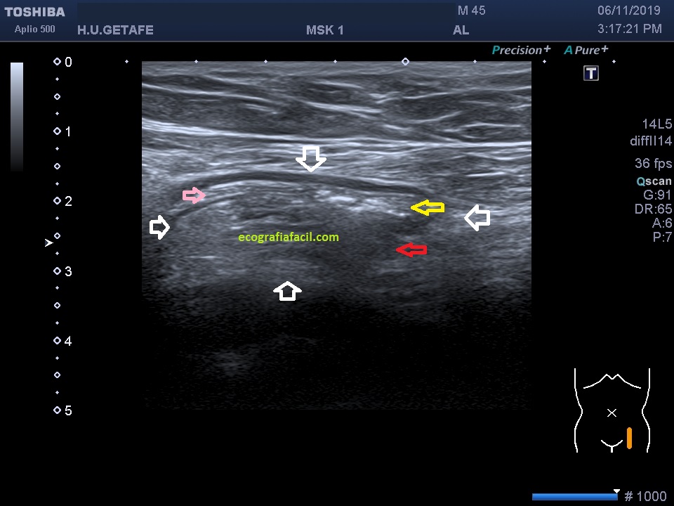 Isoecogénico – Ecografía Fácil