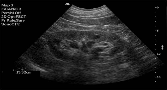 178. ¿Dilatación Renal o Quistes Renales? – Ecografía Fácil