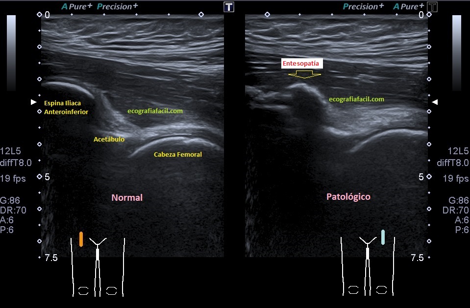 186 Entesopatía y estudio de la inserción proximal del recto anterior ...