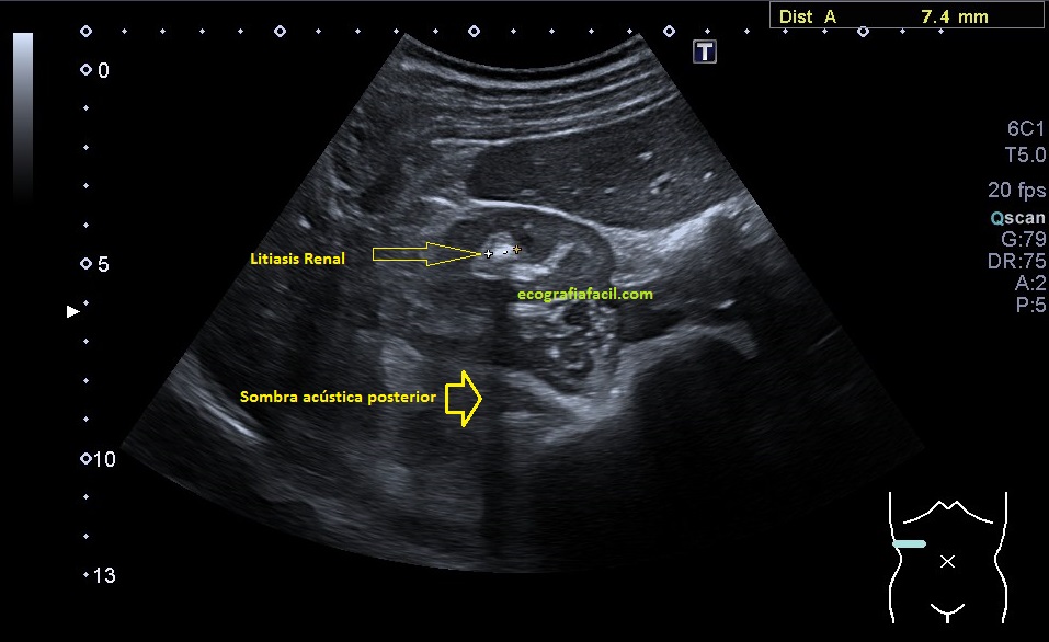 184. Litiasis renales. Rx, TC y Ecografía. – Ecografía Fácil