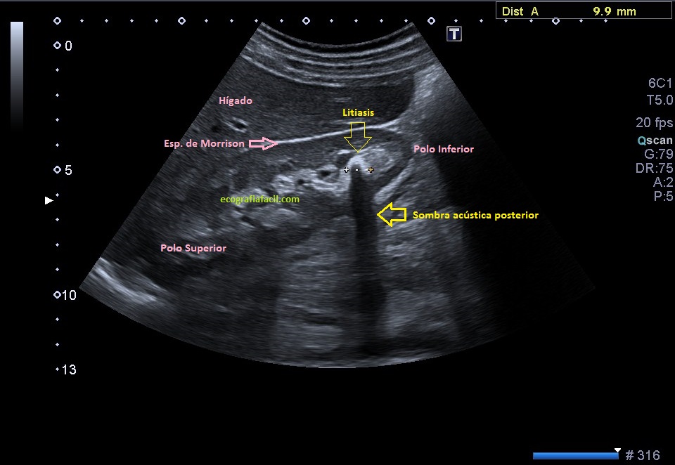 Litiasis Renal – Ecografía Fácil