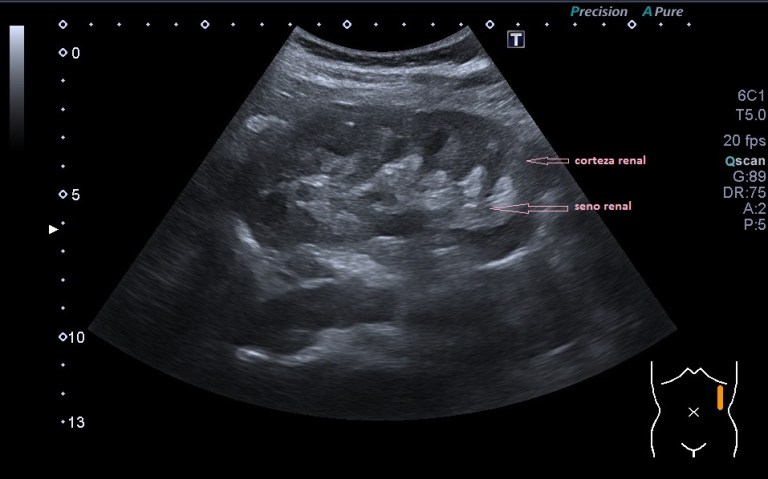 184. Litiasis renales. Rx, TC y Ecografía. – Ecografía Fácil