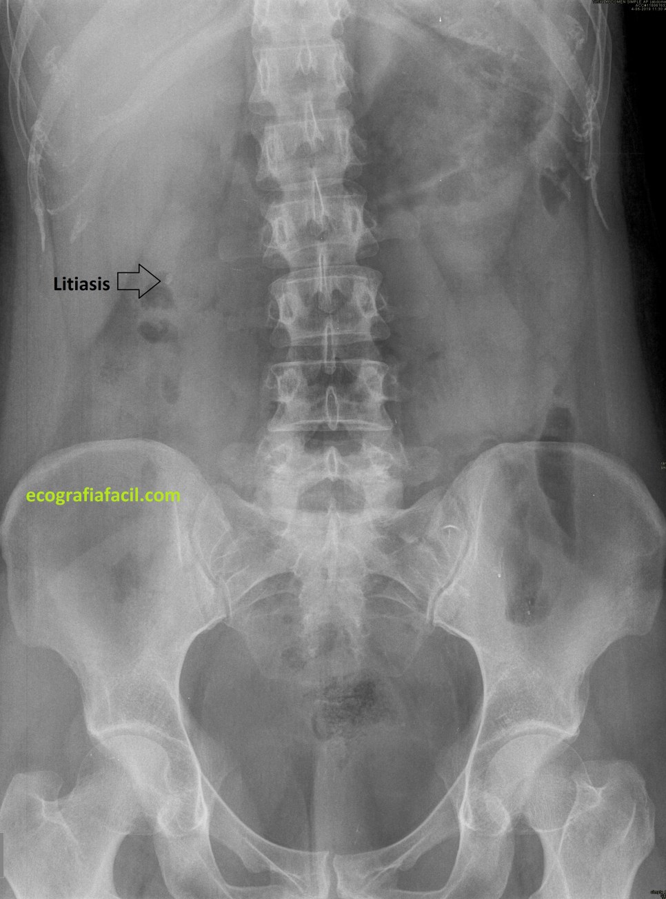 184. Litiasis renales. Rx, TC y Ecografía. – Ecografía Fácil